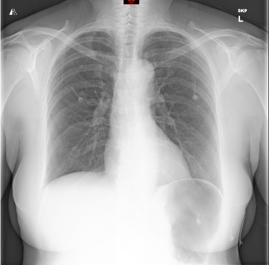 Hypovolemic Shock