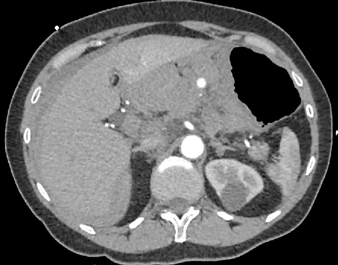 Hypovolemic Shock