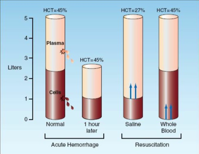 Hypovolemic Shock